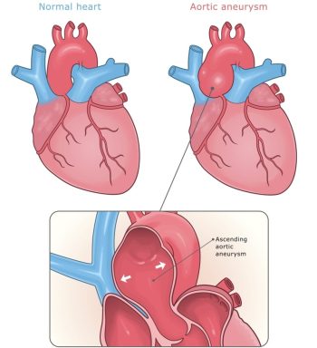 Aneurysm: Symptoms, Causes, and Treatment | Sparsh Hospital