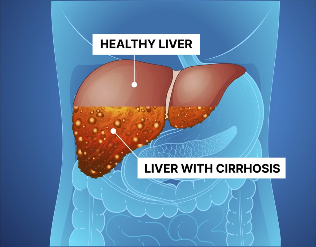 Cirrhosis Of The Liver Signs Symptoms Causes Stages