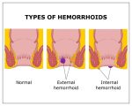 Haemorrhoids (Piles): Symptoms, Causes, and Treatments