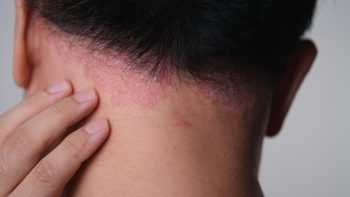 Scalp Psoriasis: Symptoms, Plaque, Causes & Treatment